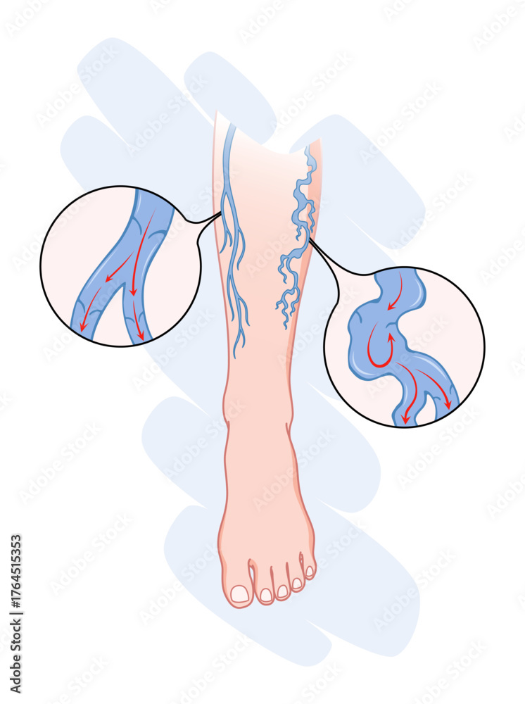 Vector de Stock Varicose veins. Blue blood vessel visible through the ...