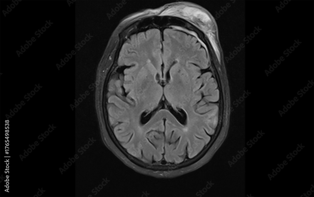 Axial Magnetic Resonance Imaging (MRI) FLAIR Sequence Showing Left ...