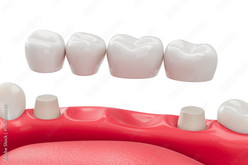 Dental bridge installation concept showing prosthetic teeth and ...