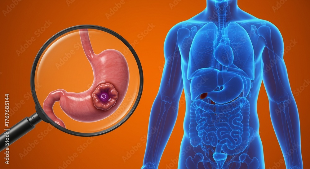 Visualization of stomach tumor growing in stomach lining, using a ...