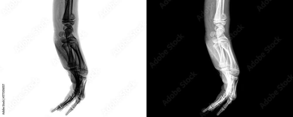 Foto de Stock Wrist Joint Lateral View X-Ray Showing Carpal Bone ...