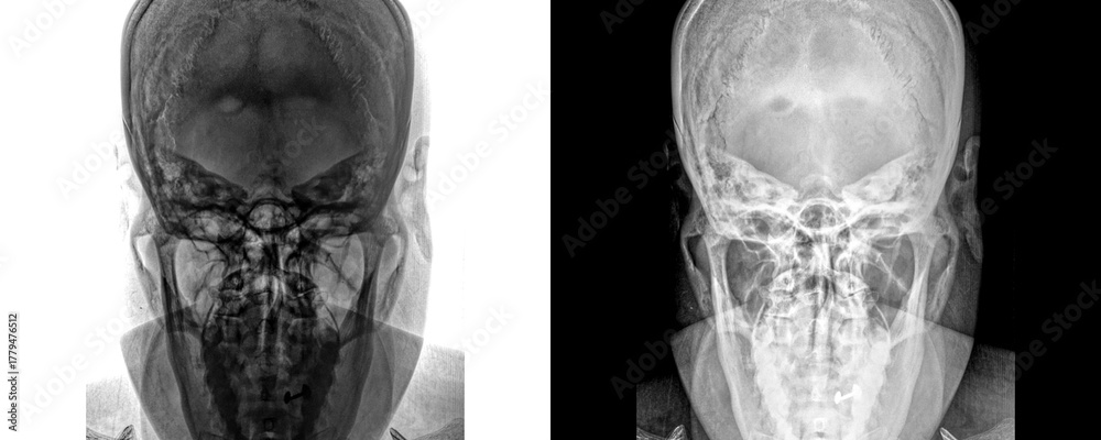 Mastoid Towns View X-Ray Image Depicting Mastoid Bone Structures and ...