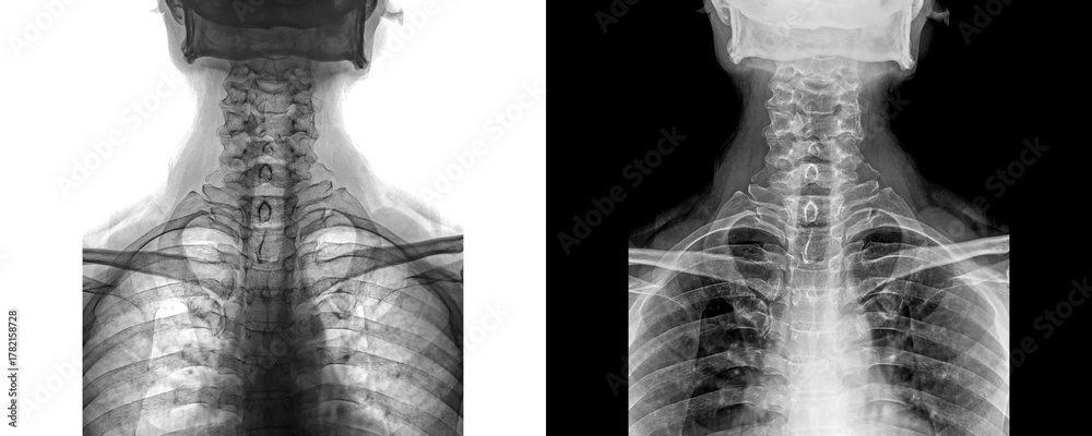 Stock-Foto „Neck Anterior View X-Ray Image Displaying Cervical ...