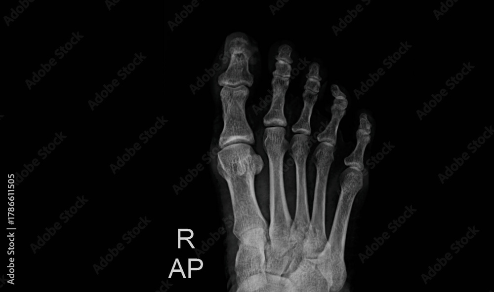 Foot X-ray showing metatarsals, phalanges and tarsal bones in ...