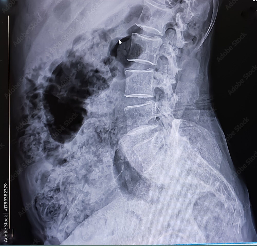 X-ray of Lumbosacral spine lateral view. Degenerative change at lumbar ...