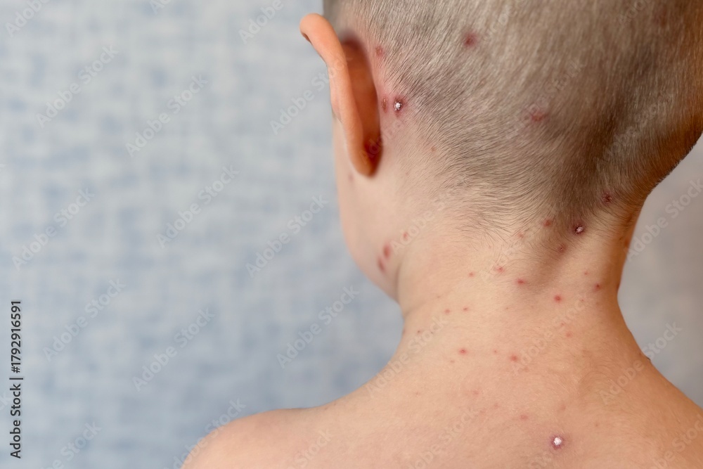 Child with chickenpox showing red rash and blisters on back caused by ...