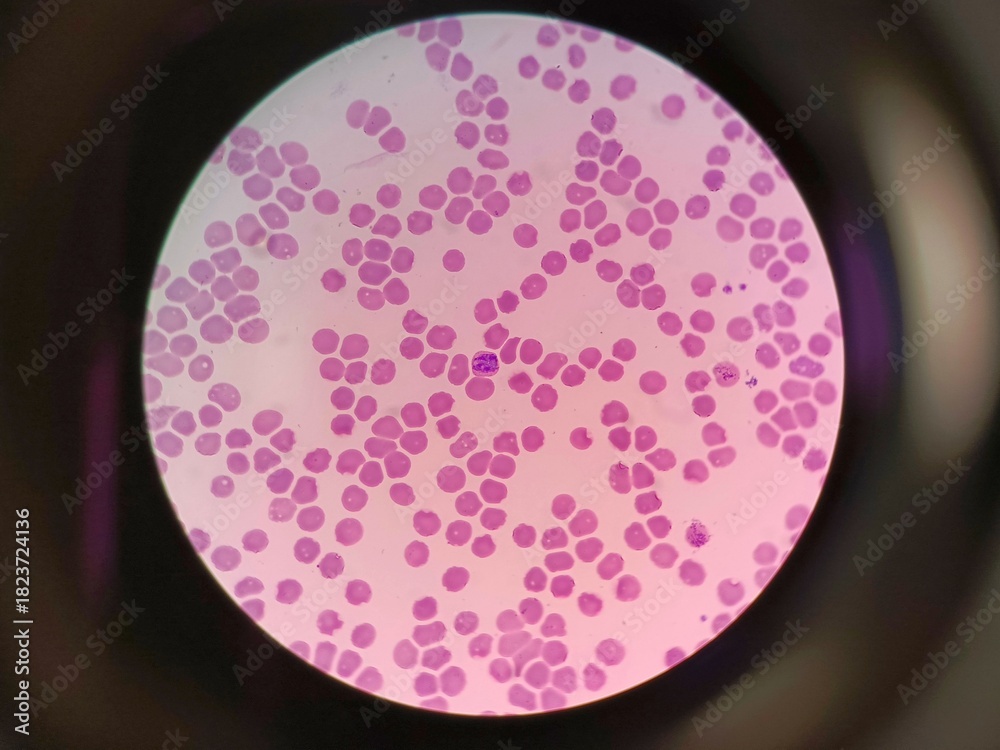 Malaria Parasite (Plasmodium spp.) in a Blood Smear, Analyzed Under a ...
