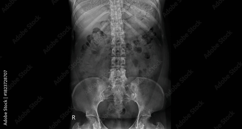 Foto de Stock Lumbar spine x-ray showing vertebrae, intervertebral ...