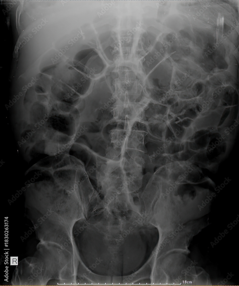 Abdominal X-ray in left lateral decubitus shows dilated bowel loops ...