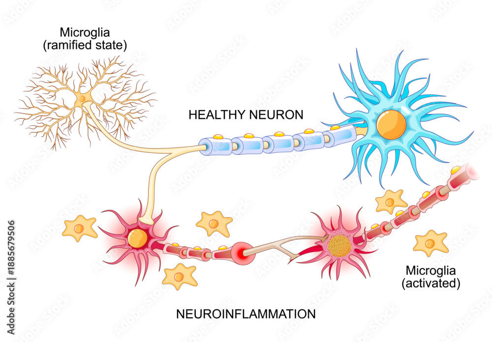 Vector de Stock Neuroinflammation. Healthy neuron and unhealthy nerve ...