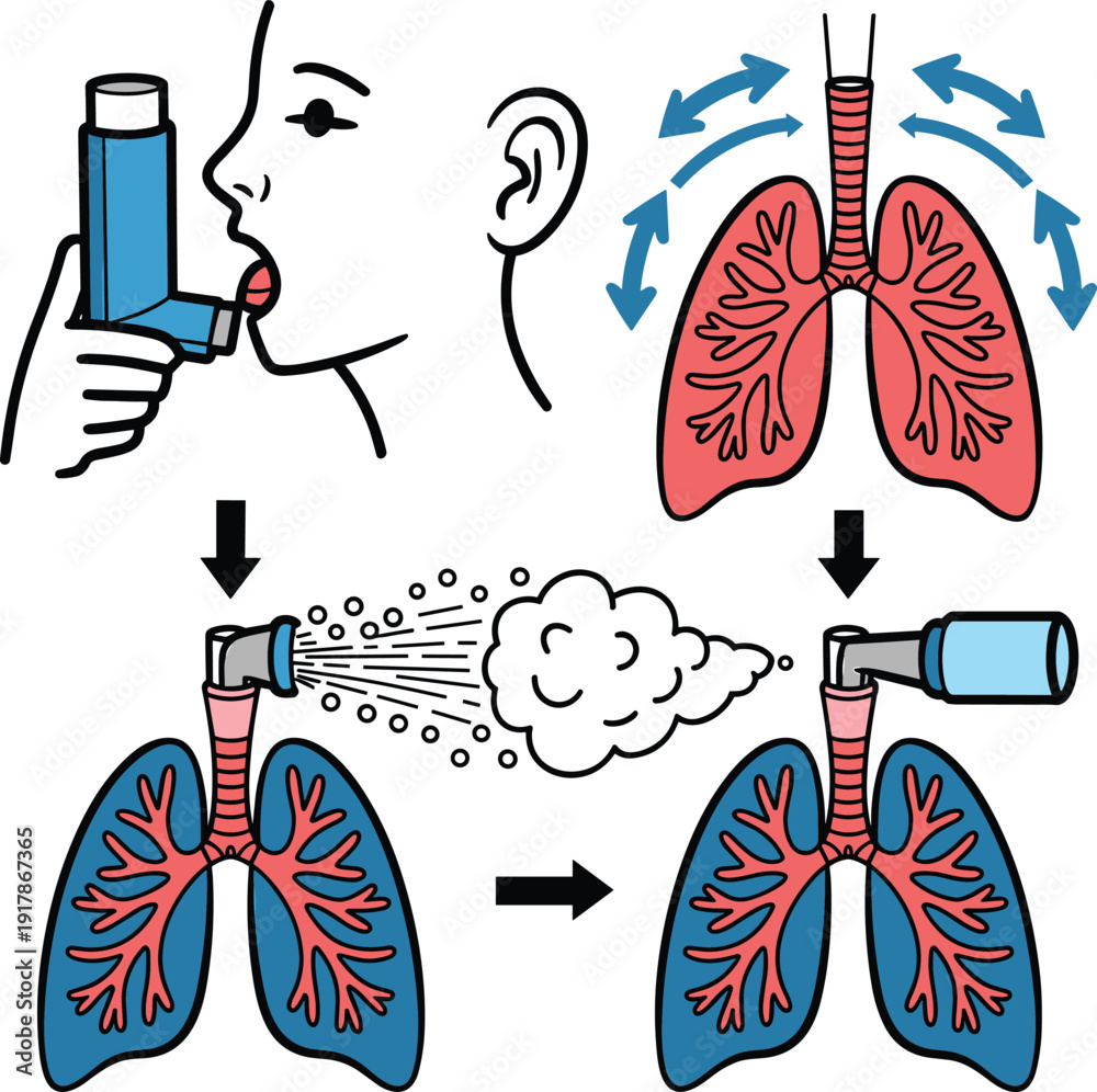 Asthma Inhaler Usage Diagram with Human Lungs and Respiratory System ...