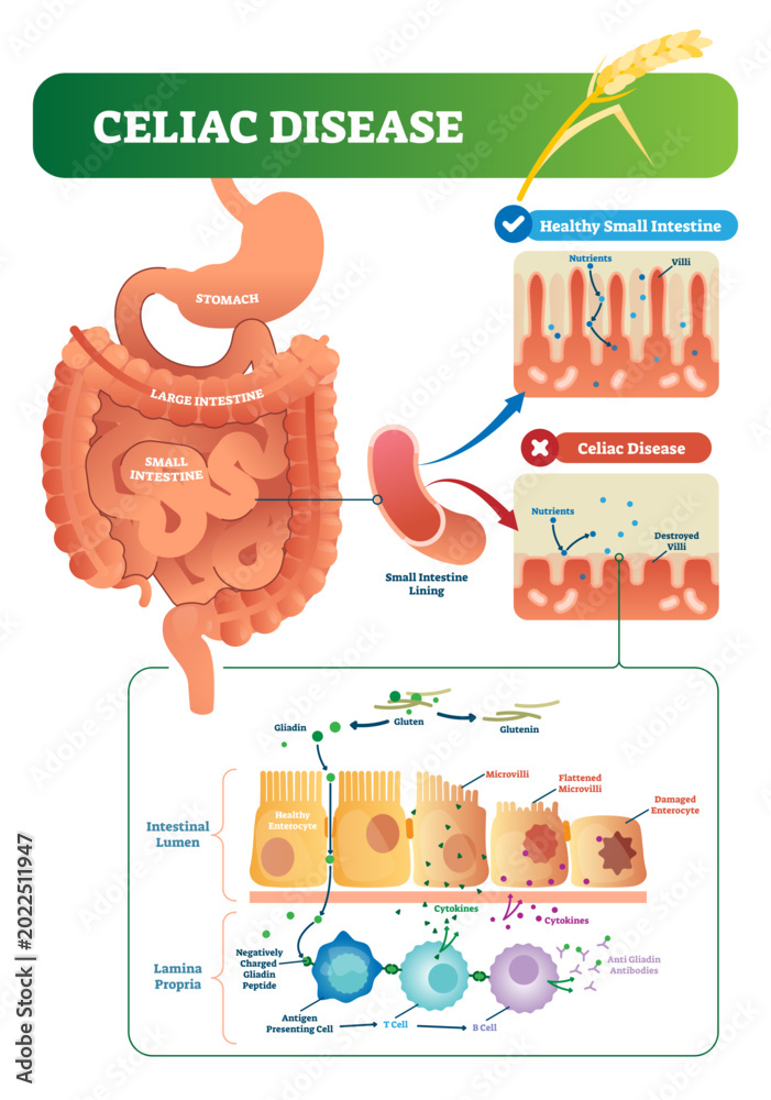 Celiac disease illustration, transparent background. Labeled diagram ...