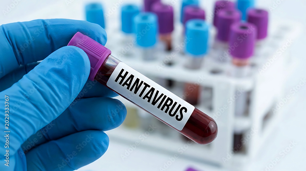 Hantavirus Blood Sample Medical Laboratory Testing Healthcare Research ...