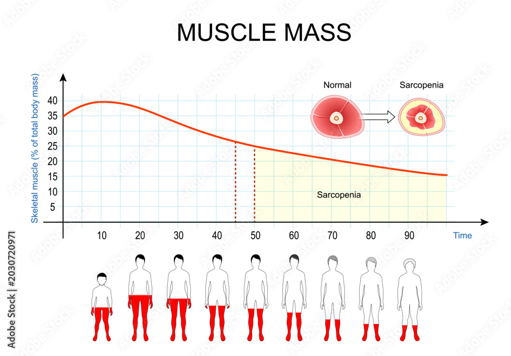 Sarcopenia and age-related muscle loss. Aging anatomy, longitudinal ...