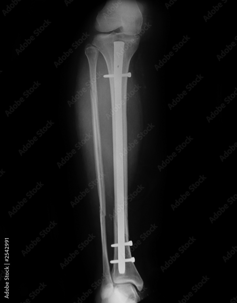 fracture de jambe Stock Photo | Adobe Stock