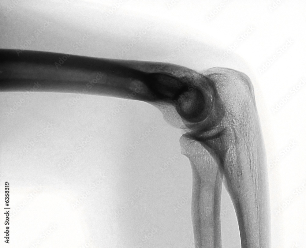 x-ray of a male bended elbow Stock Photo | Adobe Stock