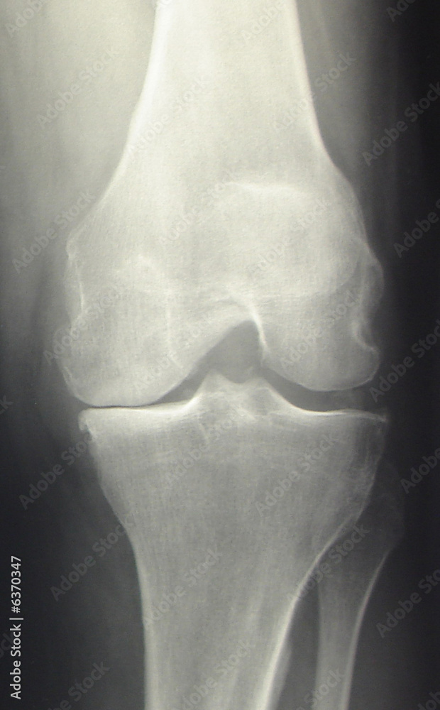 arthrose du genou Stock Photo | Adobe Stock