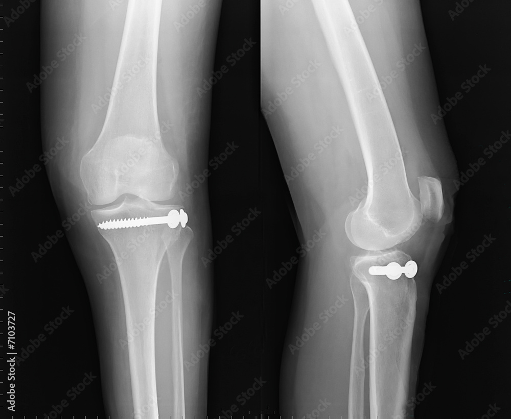 Radiographie fracture du genou Stock Photo | Adobe Stock