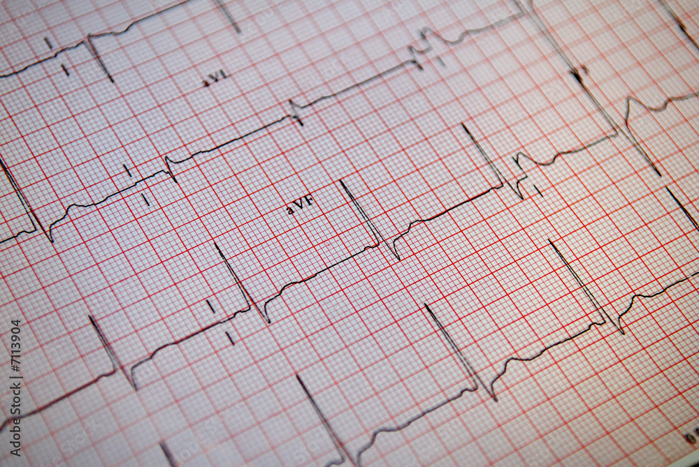 Normal ECG (EKG) Stock Photo | Adobe Stock