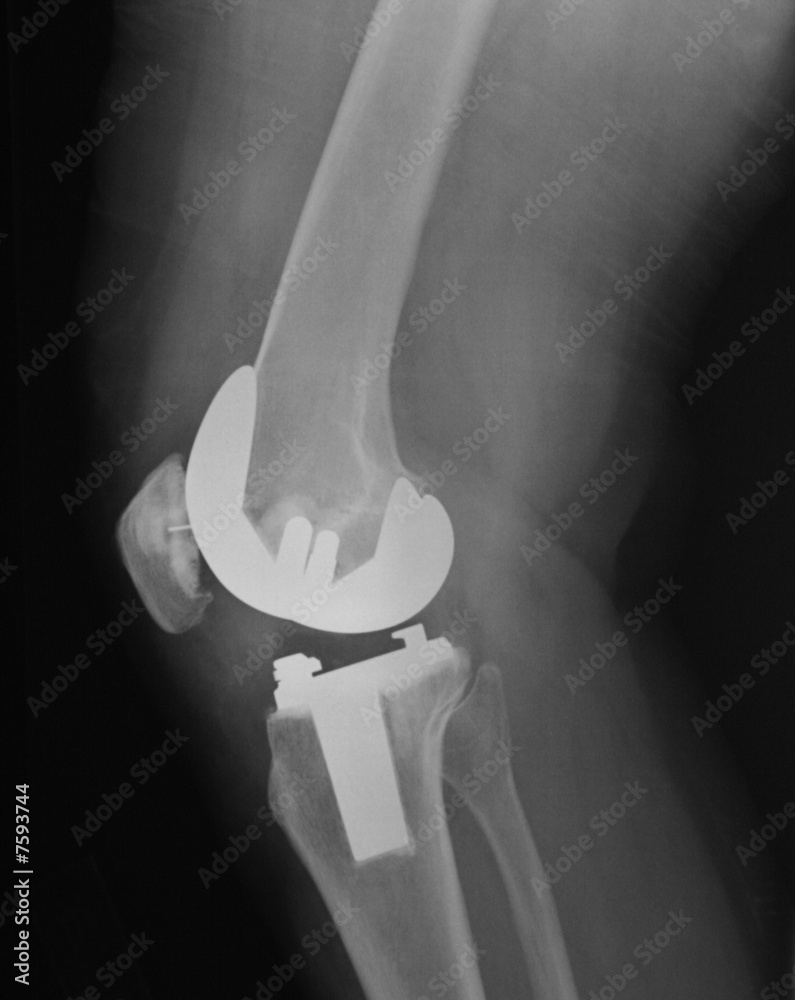 Knee Replacement X-ray lateral Stock Photo | Adobe Stock