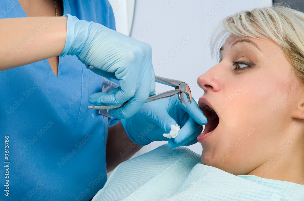 tooth extraction using forceps, scared patient Stock Photo | Adobe Stock