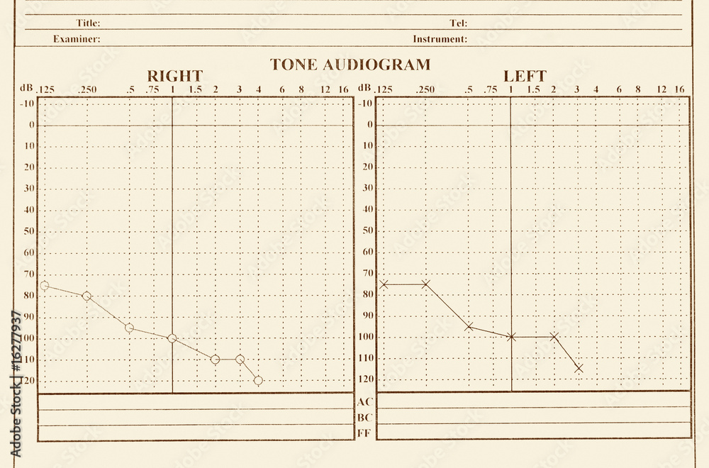 hearing medical chart showing, audiology Stock Photo | Adobe Stock