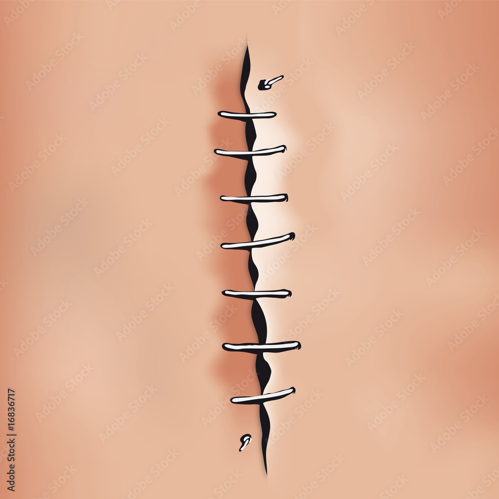 sutura vector de Stock | Adobe Stock