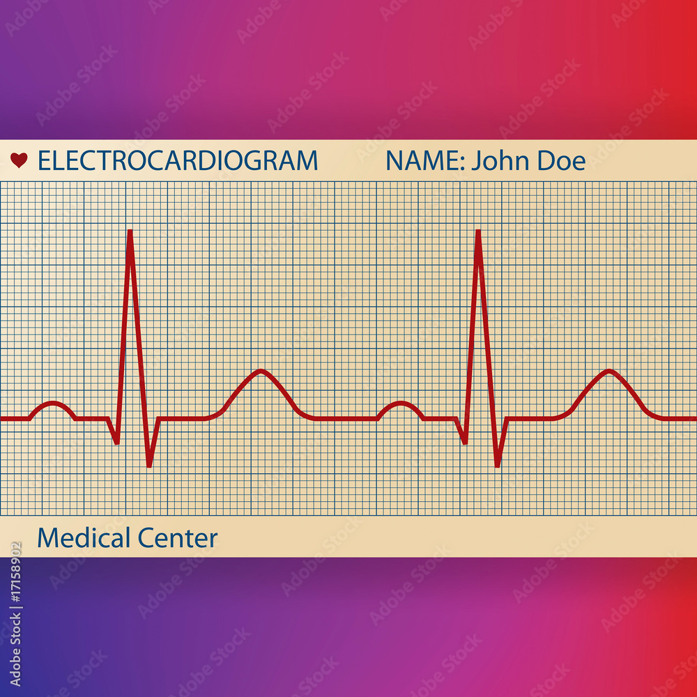 Electrocardiogram Paper with Normal ECG Graphic Line Stock Vector ...