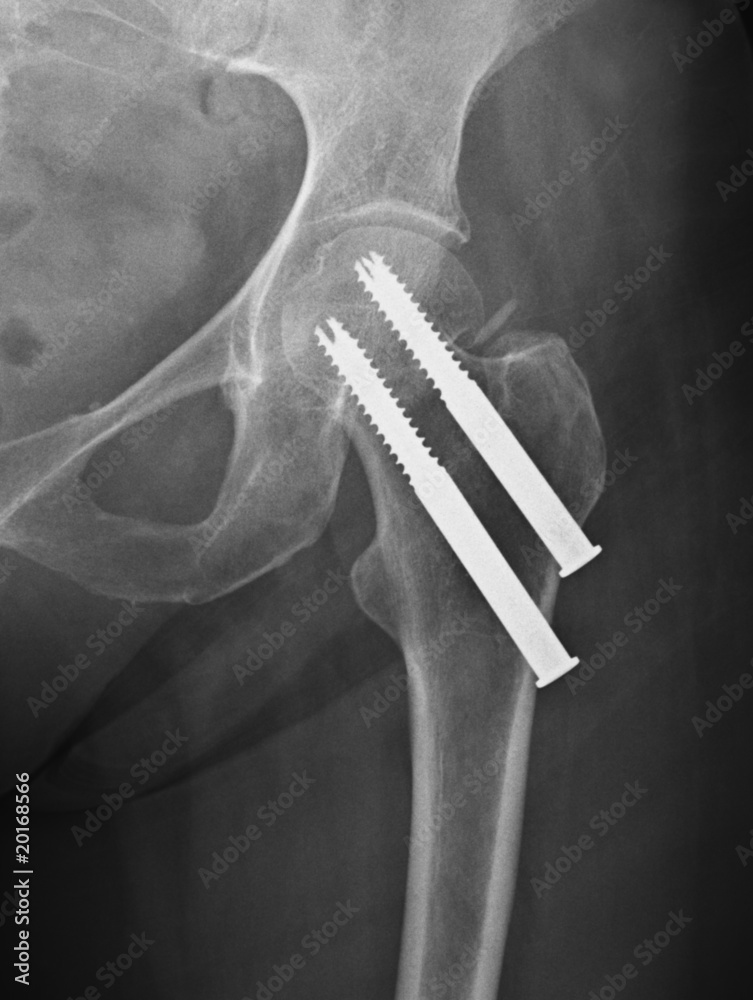 radiographie fracture col du fémur vissage Stock Photo | Adobe Stock