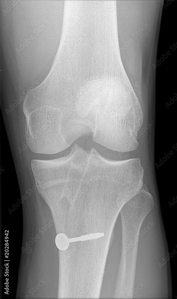Left Knee X-ray Stock Photo | Adobe Stock