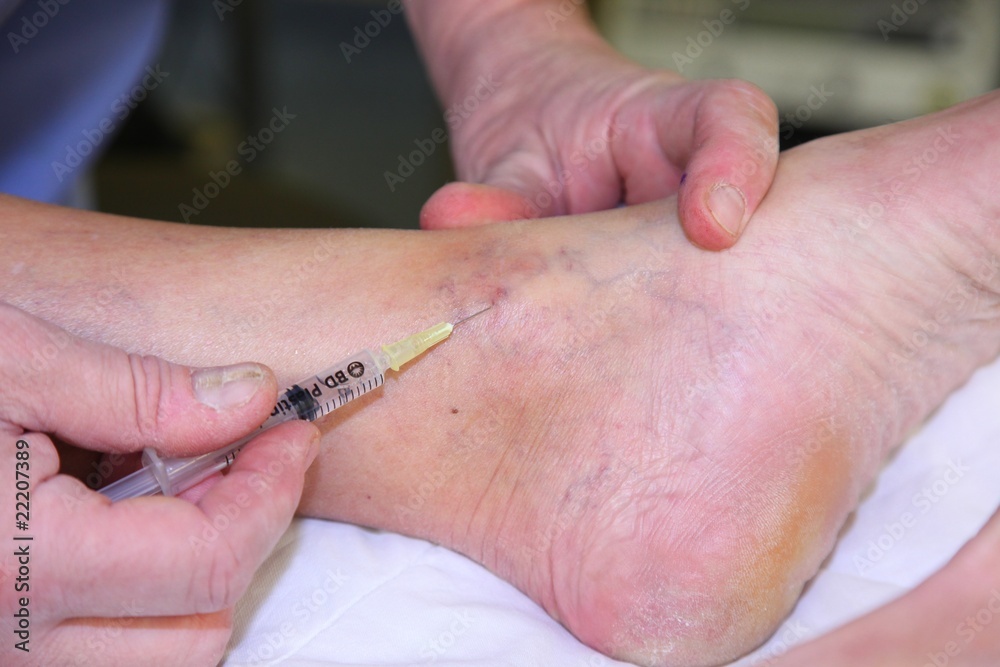 varice cheville Stock Photo | Adobe Stock