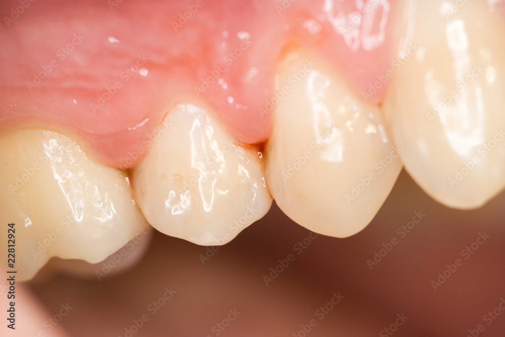 teeth, gingivitis Stock Photo | Adobe Stock