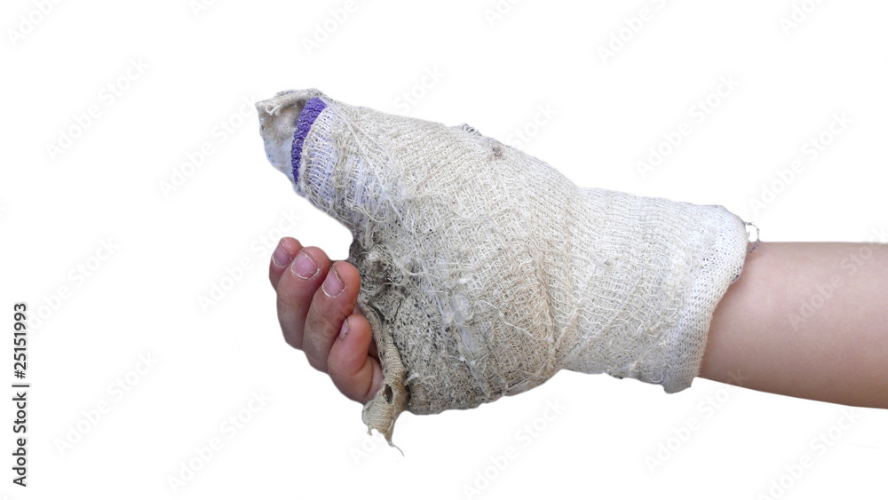 Gipshand Stock-Foto | Adobe Stock