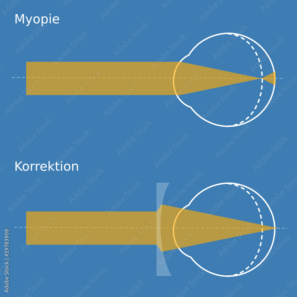 Schema Myopie mit Korrektion Stock Vector | Adobe Stock