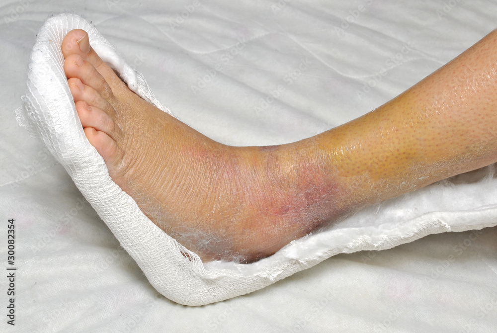 Broken leg Stock Photo | Adobe Stock