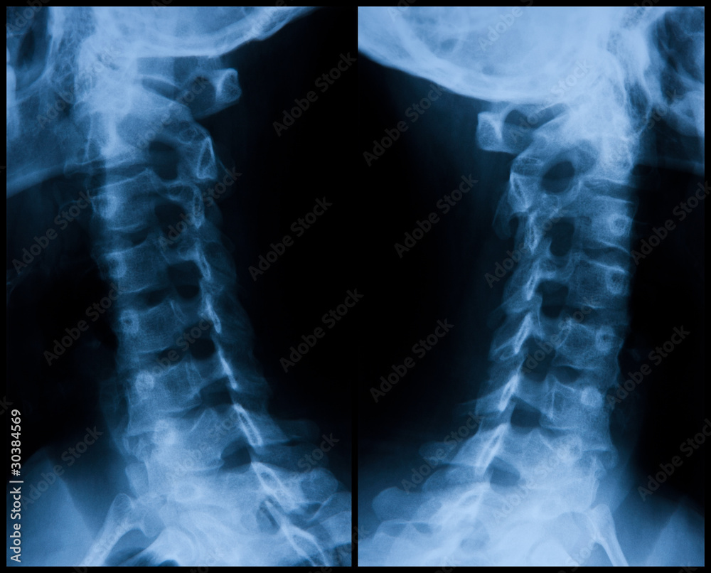 Cervical Radiograph - Left And Right Stock Photo | Adobe Stock