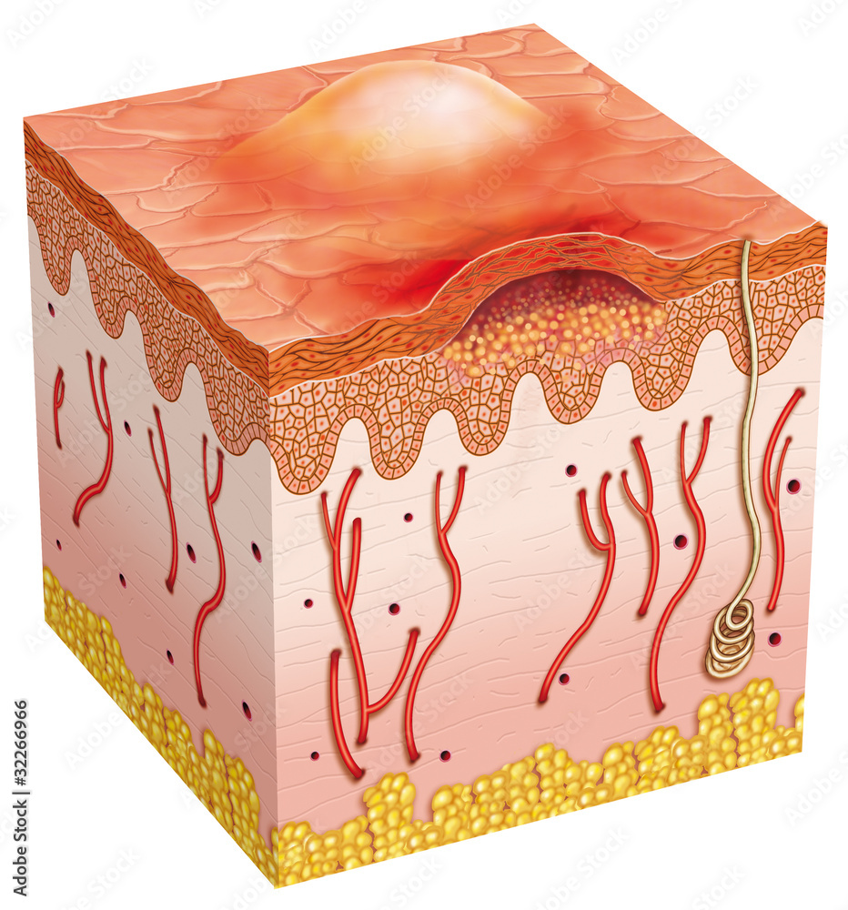pustula ilustración de Stock | Adobe Stock