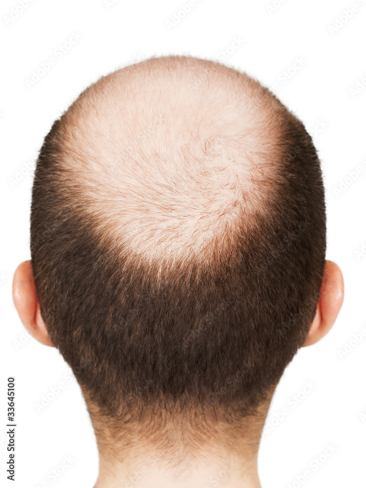 Bald men head Stock Photo | Adobe Stock