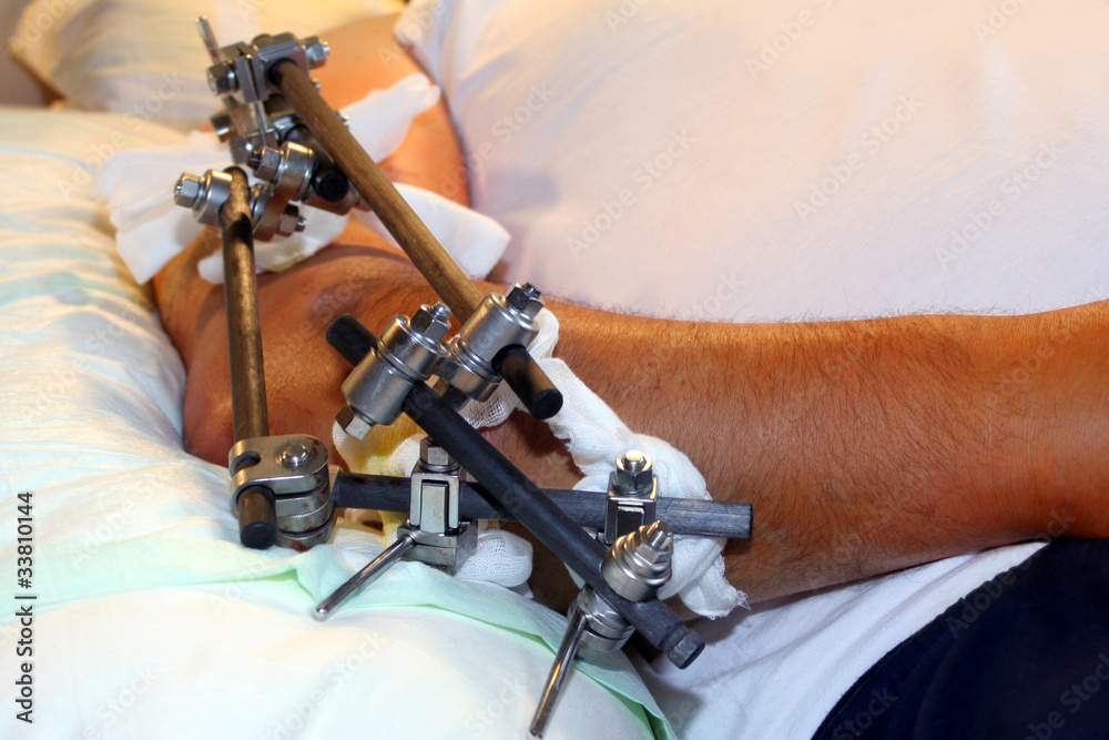 Fixierung Frakturen Stock-Foto | Adobe Stock