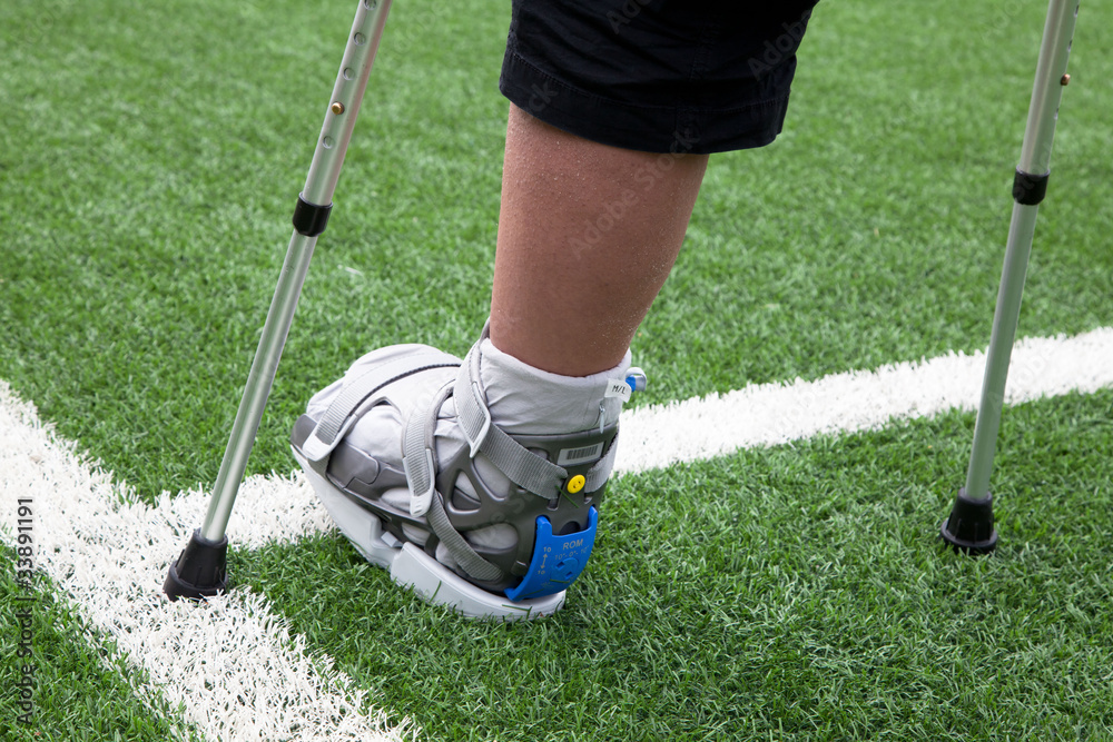 Gebrochener Fuss Stock-Foto | Adobe Stock