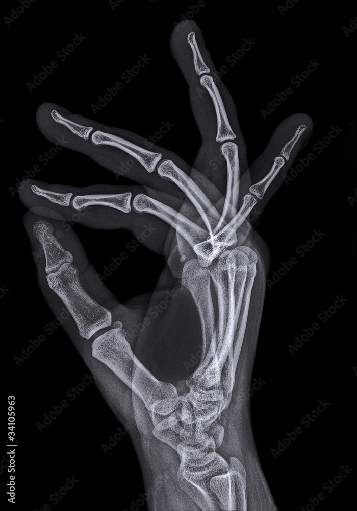 X ray radiograph of hand seen sideways spreading fingers Stock Photo ...
