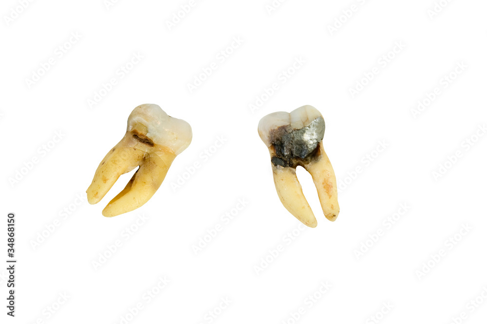 extracted molar with cavity on a white background Stock Photo | Adobe Stock
