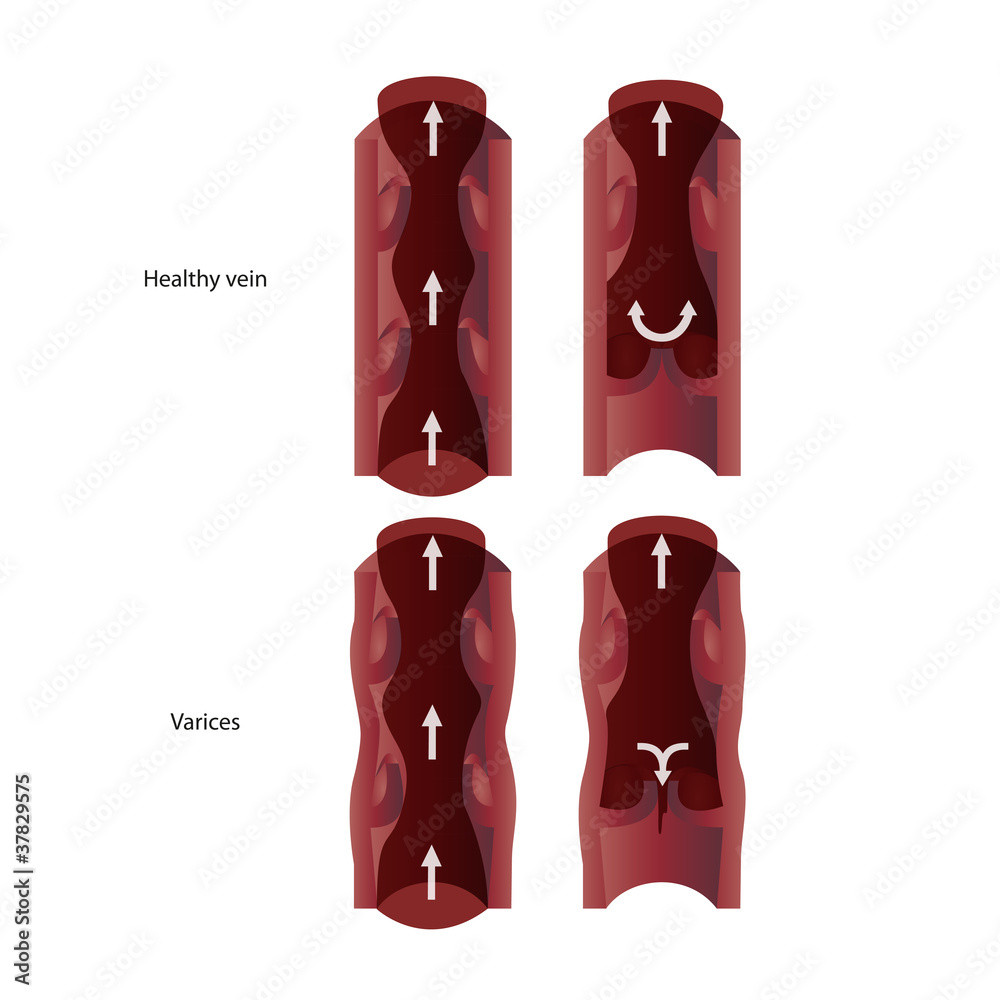 Varices eps10 vector illustration Stock Vector | Adobe Stock