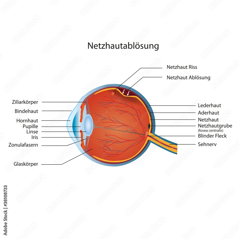 netzhaut ablösung deutsch vektor illustration Stock Vector | Adobe Stock
