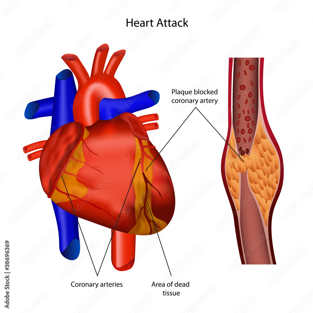 Heart Attack Diagram