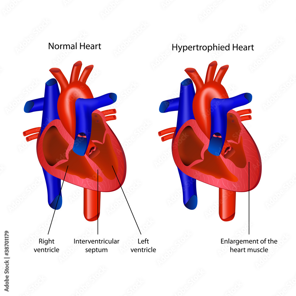 heart ventricular hypertrophy vector illustration Stock Vector | Adobe ...