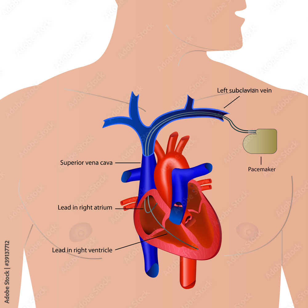 heart pacemaker englisch vector illustration Stock Vector | Adobe Stock