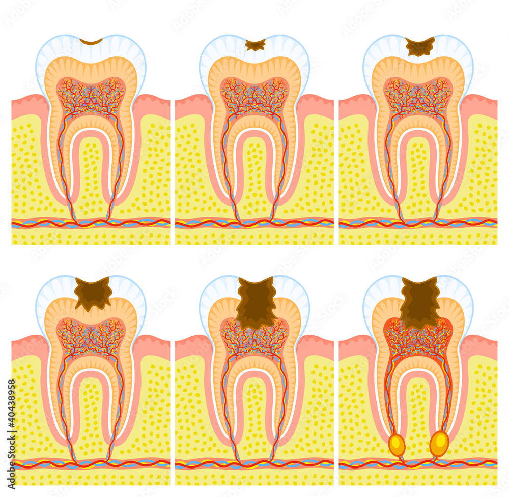 Internal structure of tooth: decay and caries Stock Vector | Adobe Stock