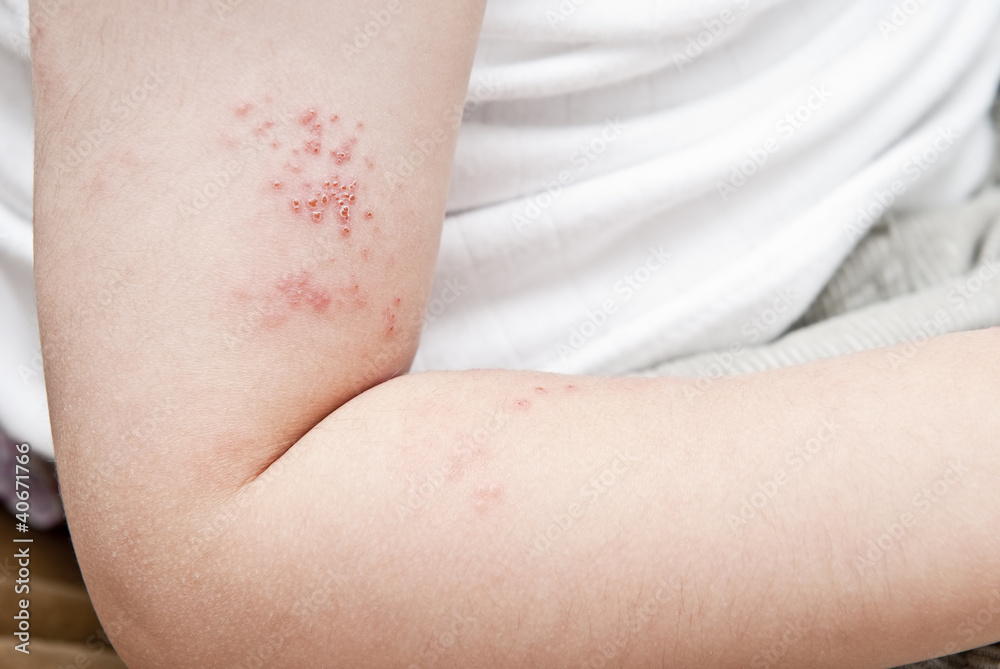 Herpes zoster. Stock-Foto | Adobe Stock