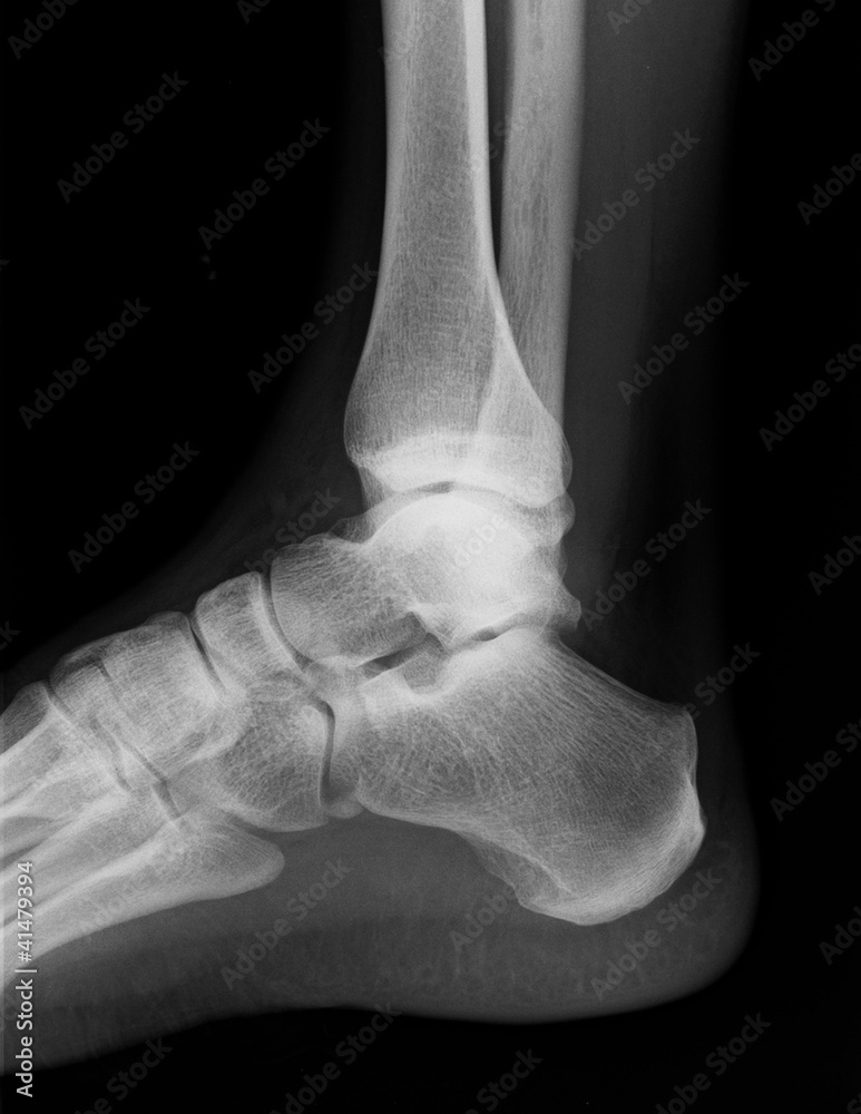 Radiografia piede Stock Photo | Adobe Stock